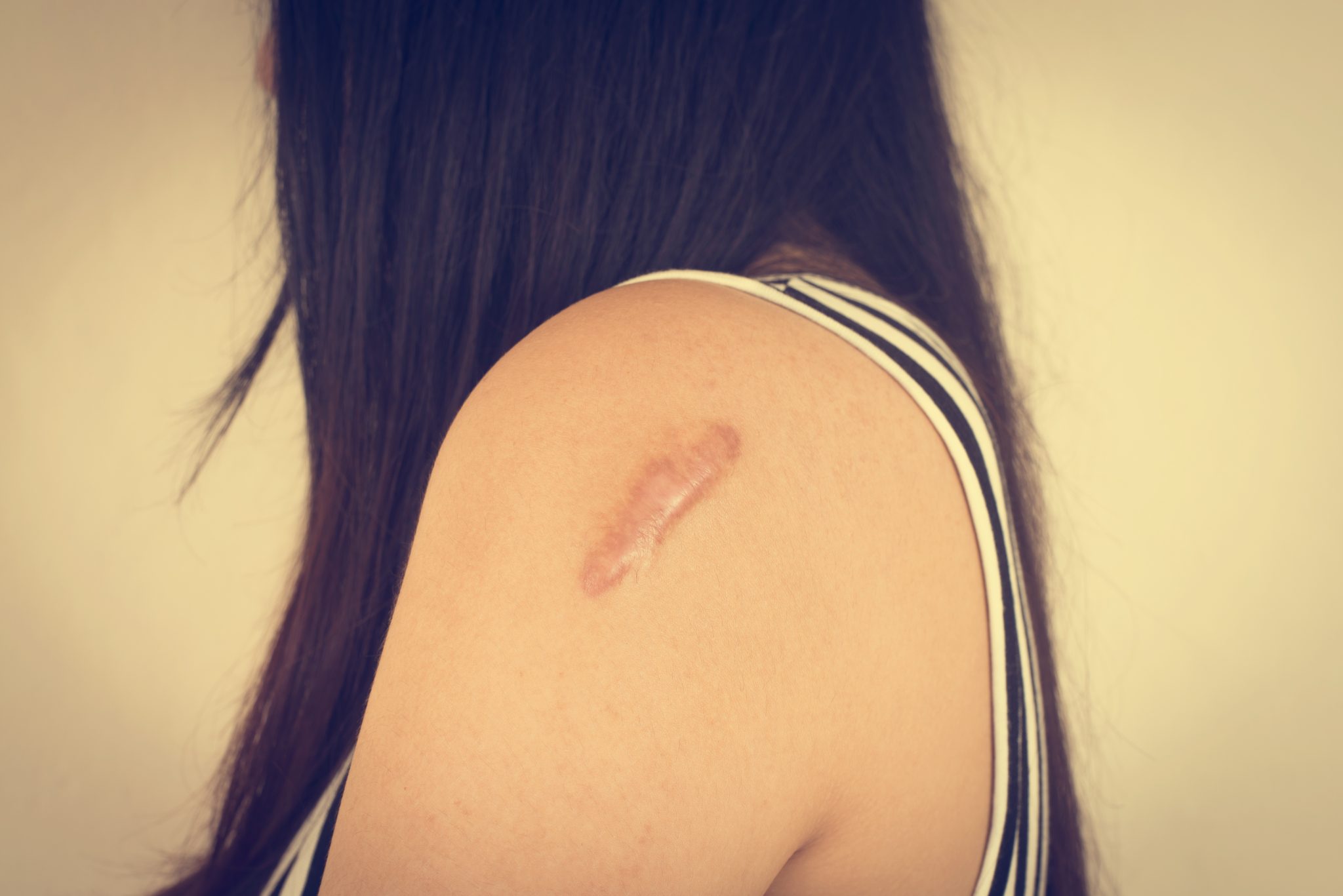 Scar Revision - Dr. Ritesh Aesthetics
